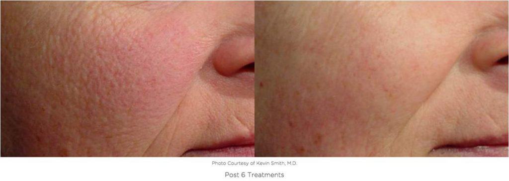 Treat Redness, Acne Scars, and Skin Texture with Laser Genesis™